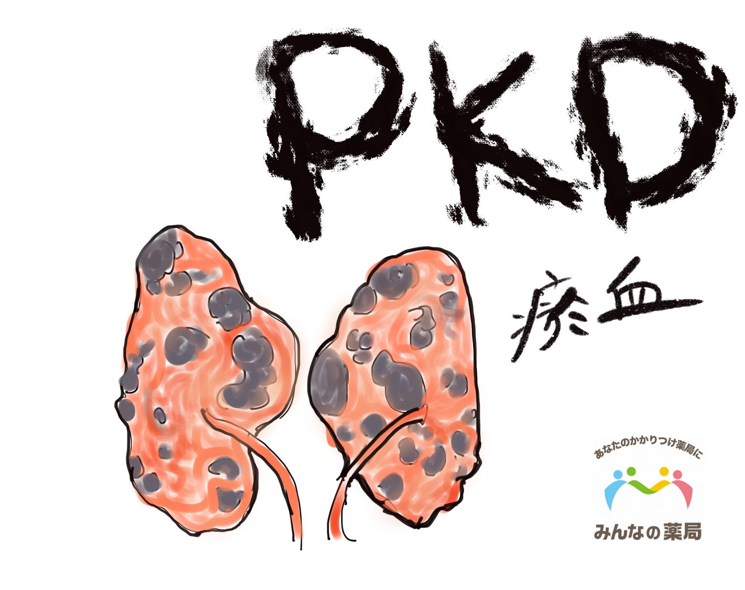 多発性嚢胞性異形成腎（MCDK）について知っておくべきこと - RxCare